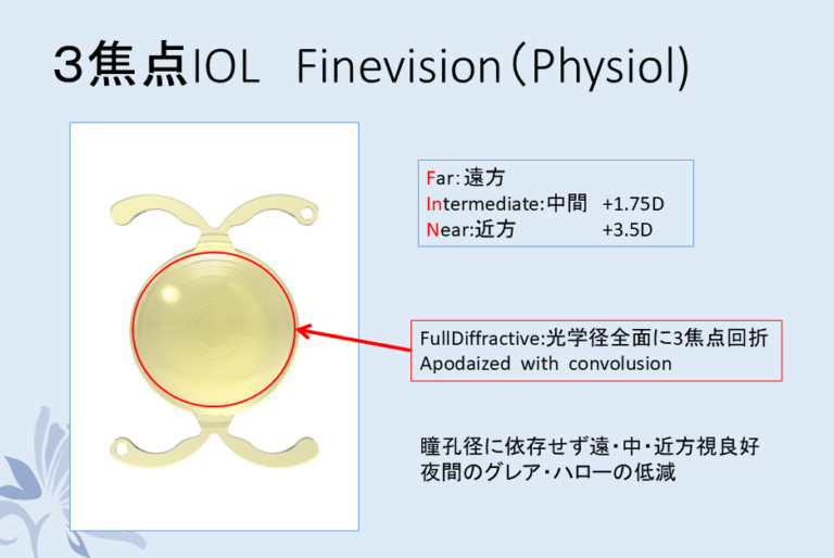 3焦点眼内レンズ Finevision HPについて｜医療法人 森井眼科クリニック｜神戸市東灘区御影駅前